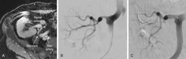 Principles of Arterial Access | Radiology Key