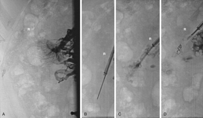 Transvenous Renal Biopsy | Radiology Key