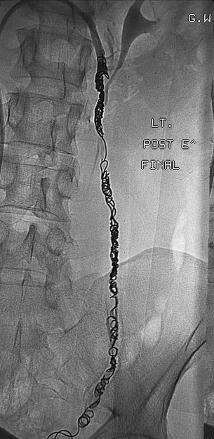 Management of Male Varicocele | Radiology Key