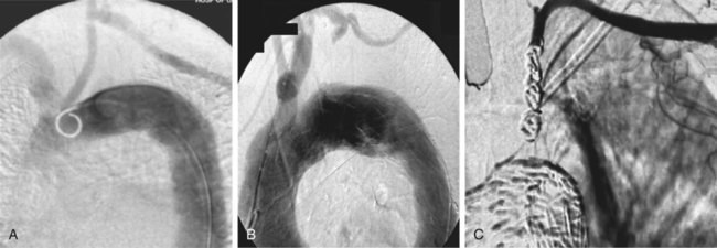 Aortic Stent-Grafts | Radiology Key