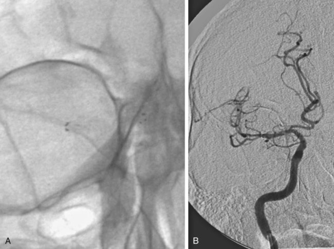 Acute Stroke Management | Radiology Key