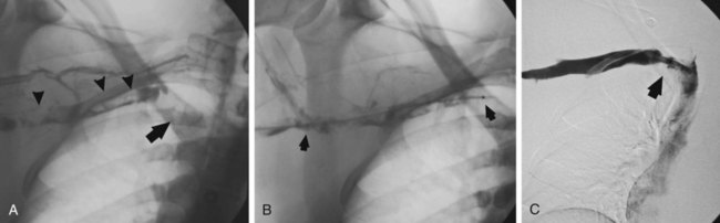 Acute Upper Extremity Deep Venous Thrombosis | Radiology Key