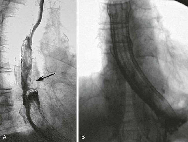 Balloon Catheters | Radiology Key