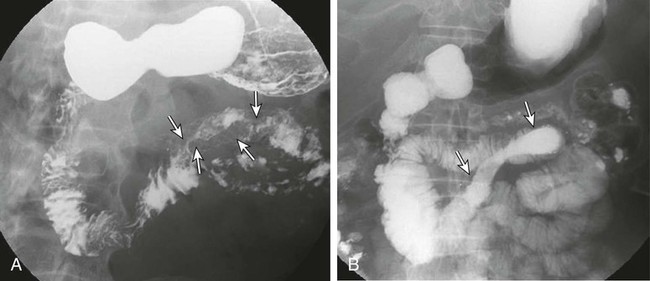 Intervention for Gastric Outlet and Duodenal Obstruction | Radiology Key