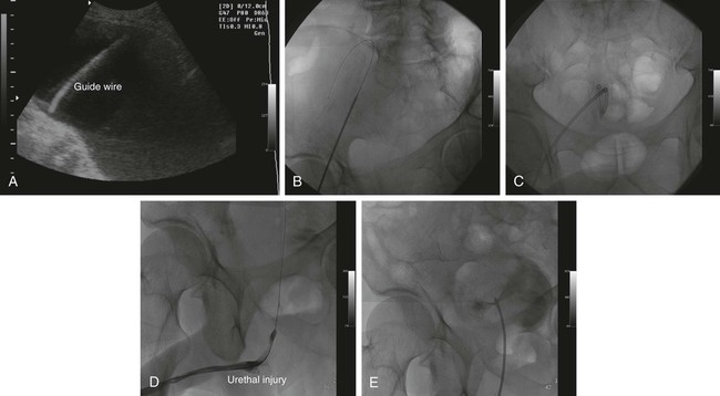 Percutaneous Nephrostomy, Cystostomy, and Nephroureteral Stenting ...