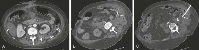 Subcutaneous Ports | Radiology Key
