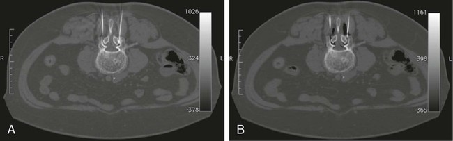 Periradicular Therapy | Radiology Key