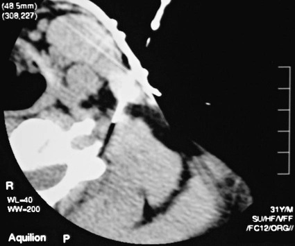 Scalene Blocks and Their Role in Thoracic Outlet Syndrome | Radiology Key