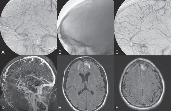 7 Stroke | Radiology Key