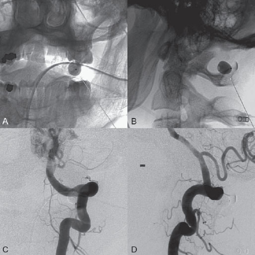 9 Spine Vascular Interventions | Radiology Key