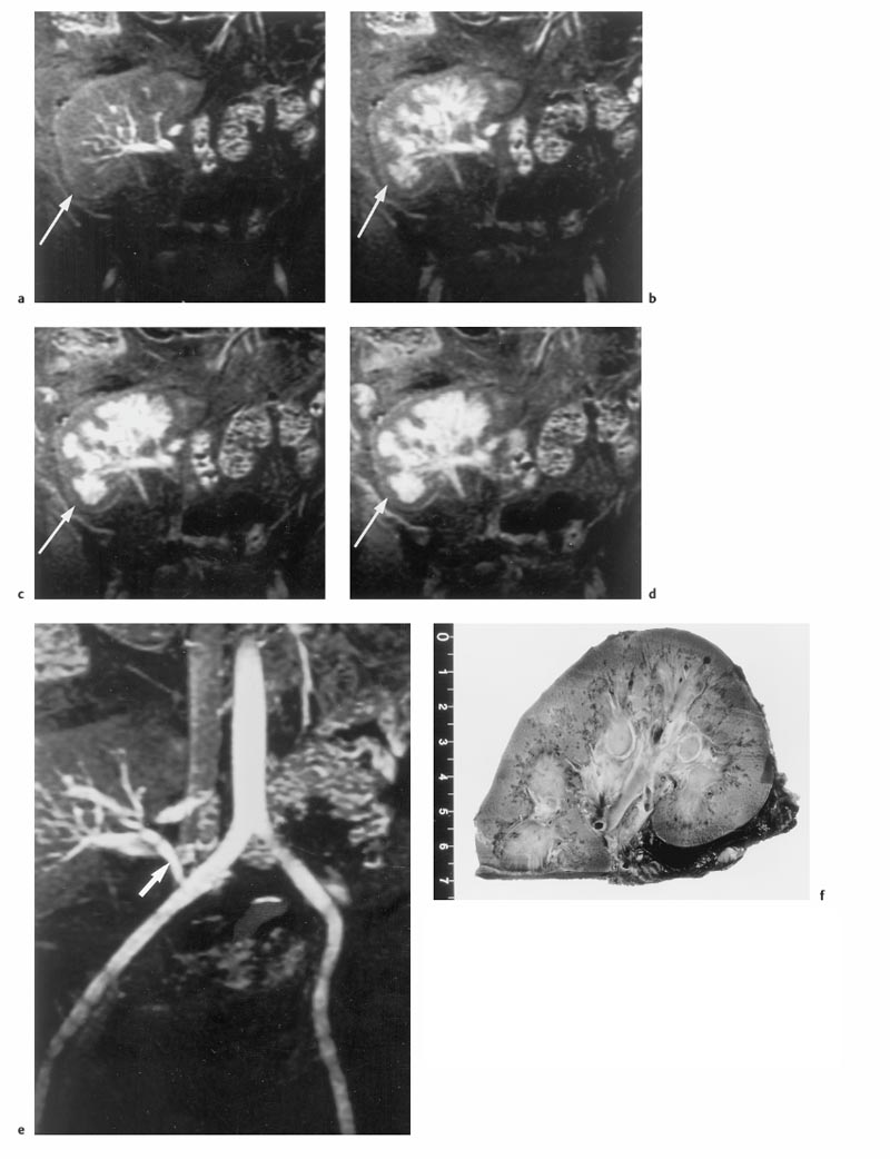 The Kidneys and Upper Urinary Tract | Radiology Key