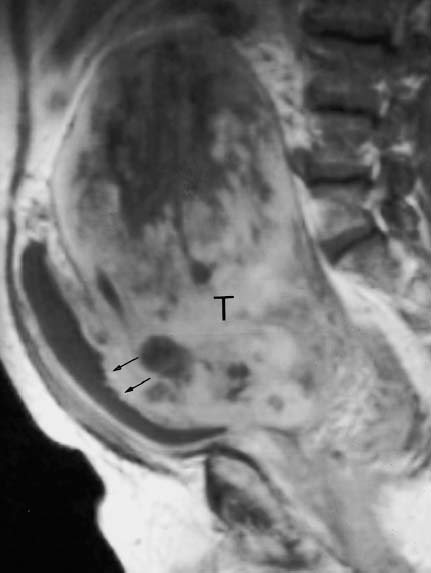 The Prostate and Seminal Vesicles | Radiology Key