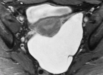 The Adnexa | Radiology Key