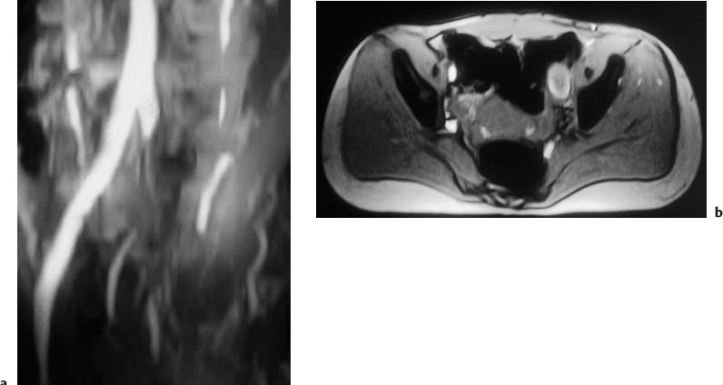 Magnetic Resonance Angiography of the abdomen | Radiology Key