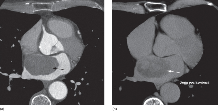 Cardiac Disorders | Radiology Key