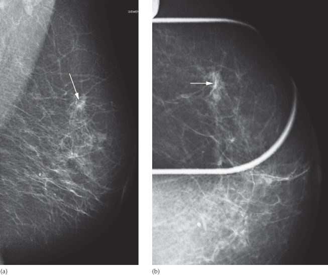Breast Imaging | Radiology Key
