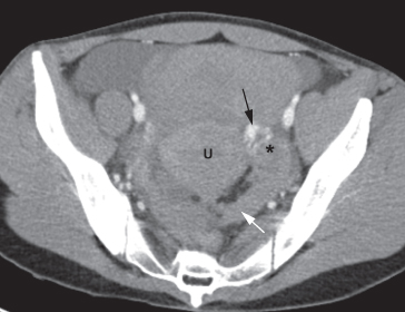 Female Genital Tract | Radiology Key