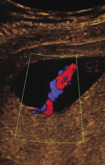 Based on Ultrasound Reflection | Radiology Key