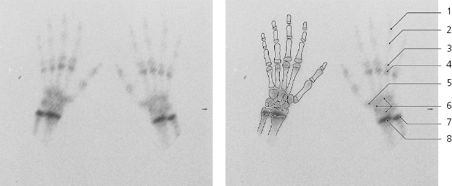 and Hand | Radiology Key