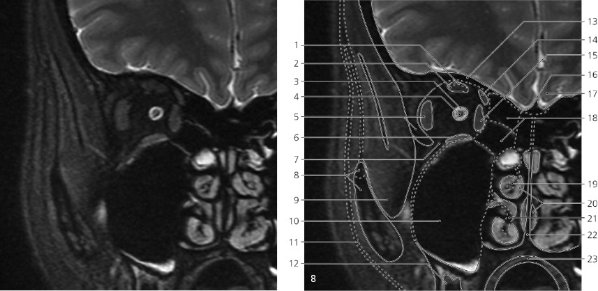 Orbita | Radiology Key