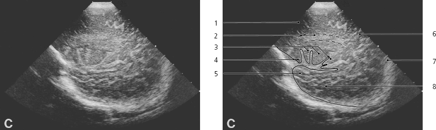 Newborn | Radiology Key