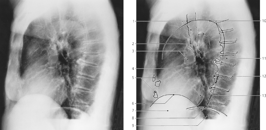 Cage | Radiology Key