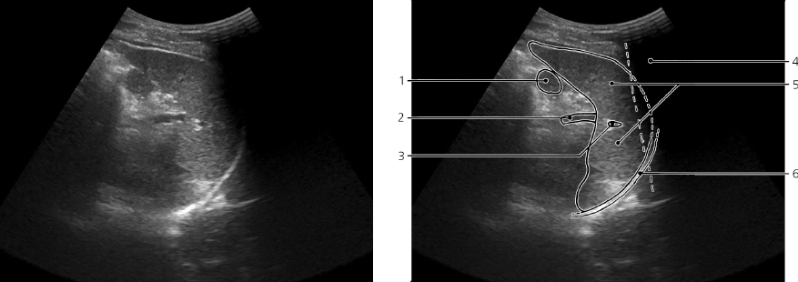 Spleen | Radiology Key