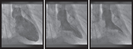 Left ventricular function | Radiology Key