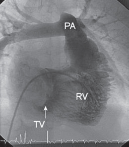 Right ventricle | Radiology Key