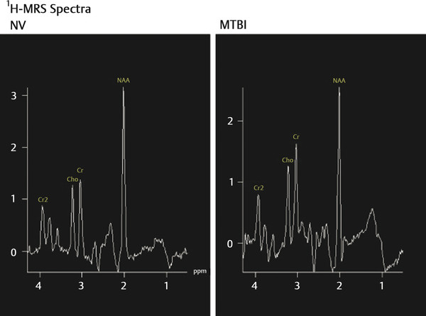 Advanced Imaging in Mild Traumatic Brain Injury and Concussion ...