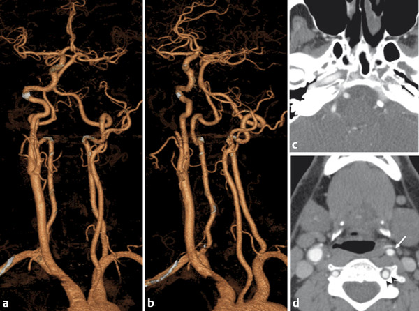3: The Carotid Segments, the Aberrant ICA, and the Persistent Stapedial ...