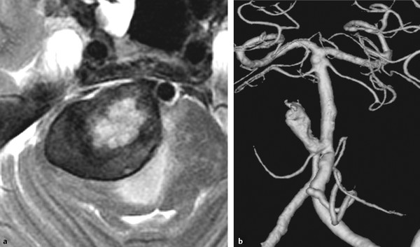 21: The Brainstem Perforators | Radiology Key