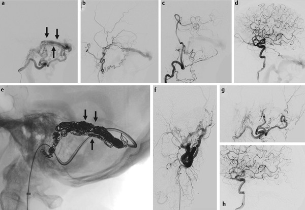 32: The Superior Sagittal and Transverse Sinuses | Radiology Key