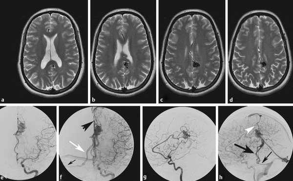 38: The Infratentorial Veins | Radiology Key