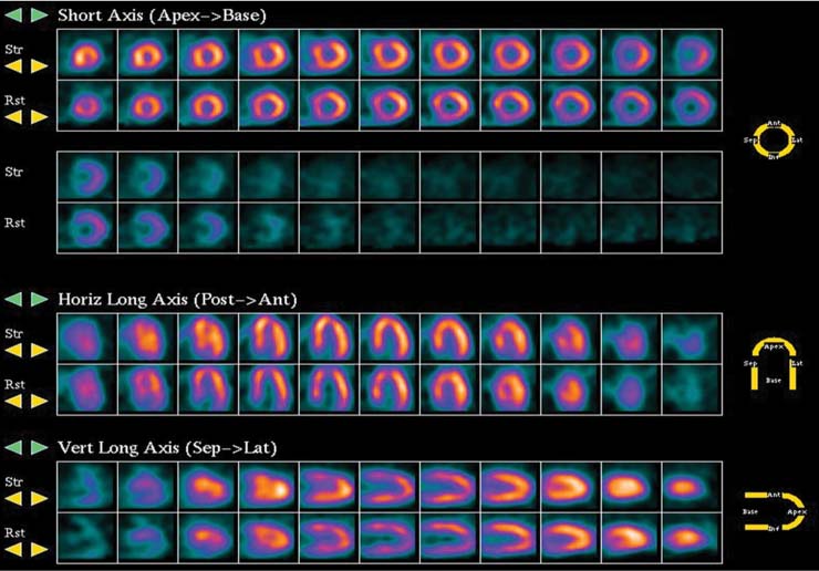 35 Diaphragmatic Attenuation Artifact | Radiology Key