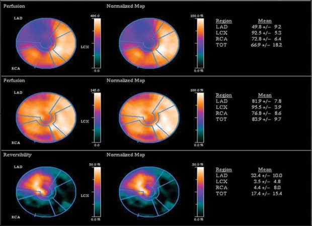 35 Diaphragmatic Attenuation Artifact | Radiology Key