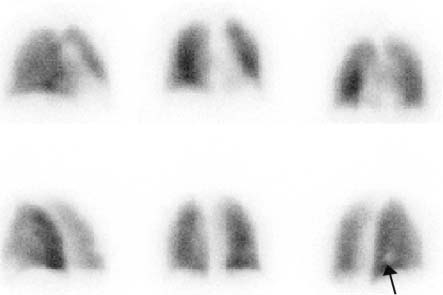 52 MAA Clumping | Radiology Key