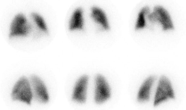 52 MAA Clumping | Radiology Key