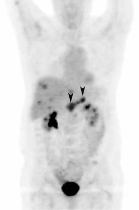 78 Pancreatic Cancer | Radiology Key