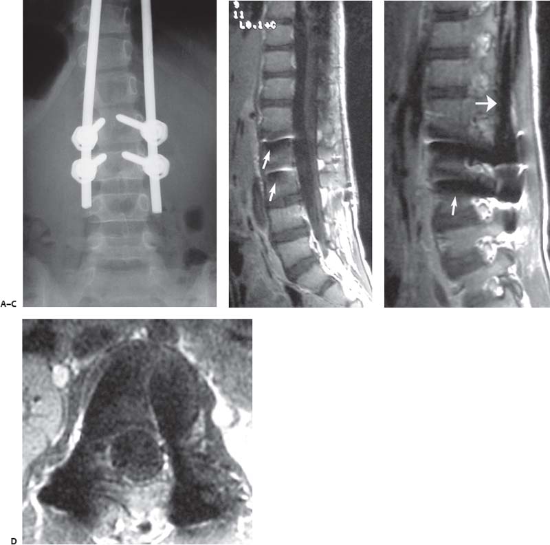 The Pediatric Spine | Radiology Key
