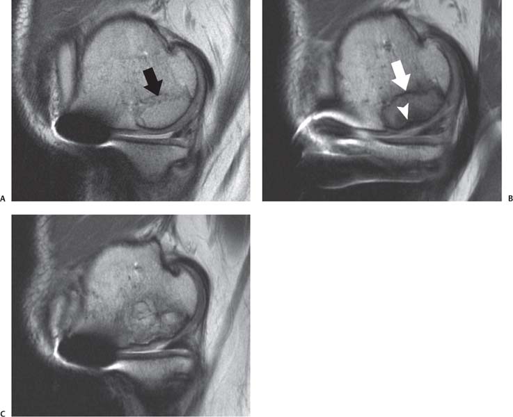 Articular Cartilage | Radiology Key