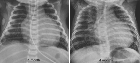 Hypoplastic Left Heart Syndrome | Radiology Key