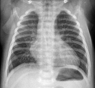 Double-Outlet Ventricles | Radiology Key