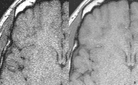 Multichannel Coil Technology: Introduction | Radiology Key