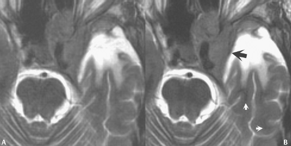 Imaging Basics: Signal-to-Noise Ratio (SNR) | Radiology Key