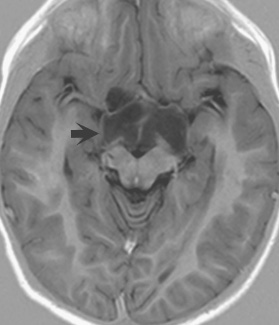 Inversion Recovery: Part 2 | Radiology Key