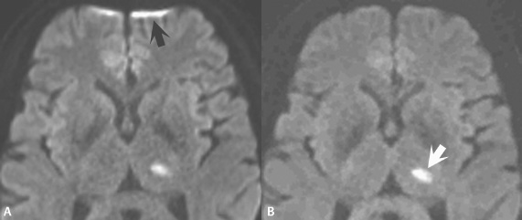 Imaging Basics: Contrast-to-Noise Ratio (CNR) | Radiology Key