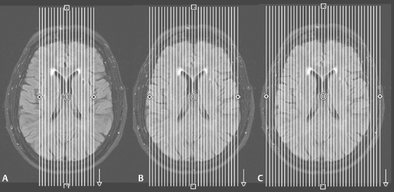 Slice Thickness | Radiology Key