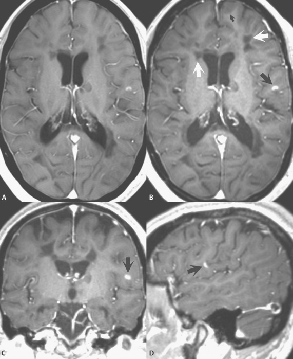 3D Imaging: MP-RAGE | Radiology Key