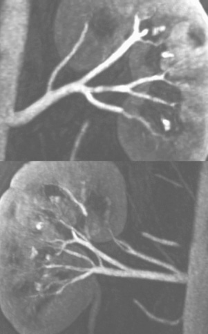 Contrast-Enhanced MRA: Basics; Renal, Abdomen | Radiology Key